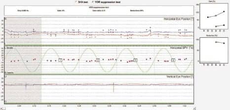 In the Trenches, Part 3: Caloric and Rotational Chair Tests | The ...