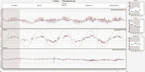 In the Trenches, Part 3: Caloric and Rotational Chair Tests | The ...