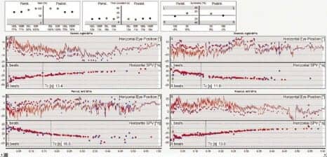 In the Trenches, Part 3: Caloric and Rotational Chair Tests | The ...