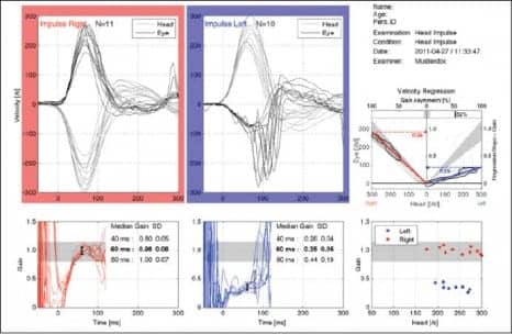 Video Head Impulse Testing (vHIT): VOR Analysis of High Frequency ...