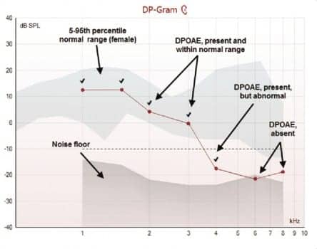 An Overview of OAEs and Normative Data for DPOAEs | The Hearing Review