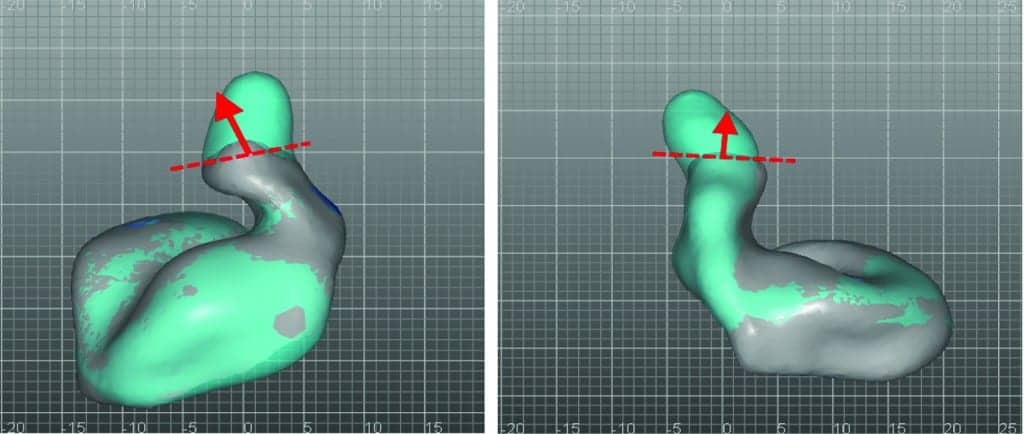 An Innovative Otoblock that Enables Deeper Impression Taking | The ...