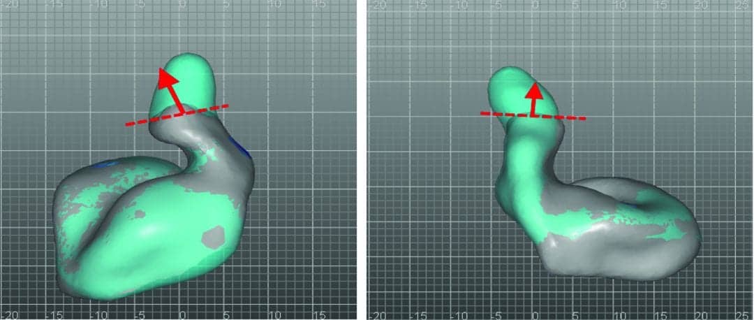 An Innovative Otoblock that Enables Deeper Impression Taking | The ...