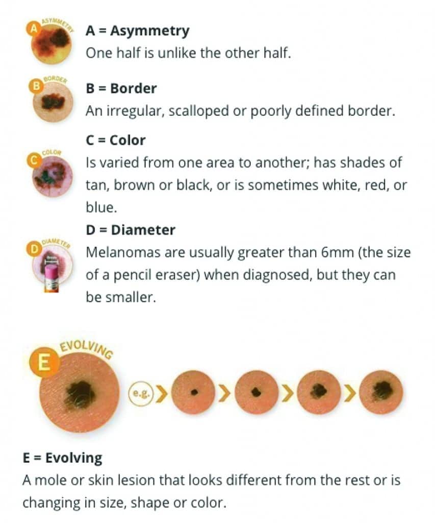 A Skin Cancer Screening Model for Hearing Care Professionals | The ...