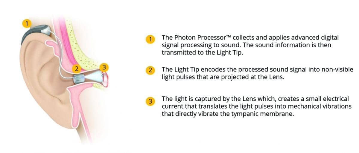 The Earlens Light-Driven Hearing Aid: Top 10 Questions and Answers ...