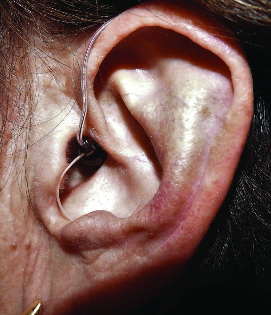 A Simple and Expedient Method to Facilitate Receiver-in-Canal (RIC) Non ...