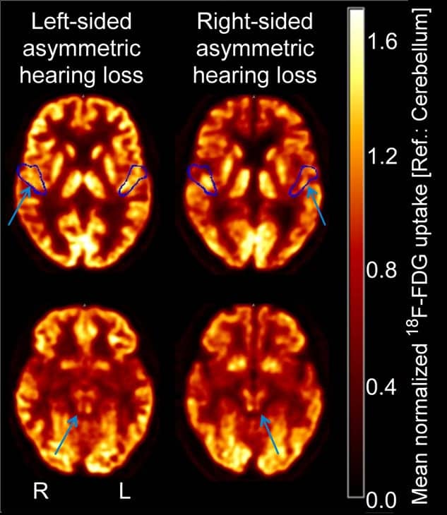 High-Resolution PET/CT Imaging Assesses Brain Stem Function in Patients ...