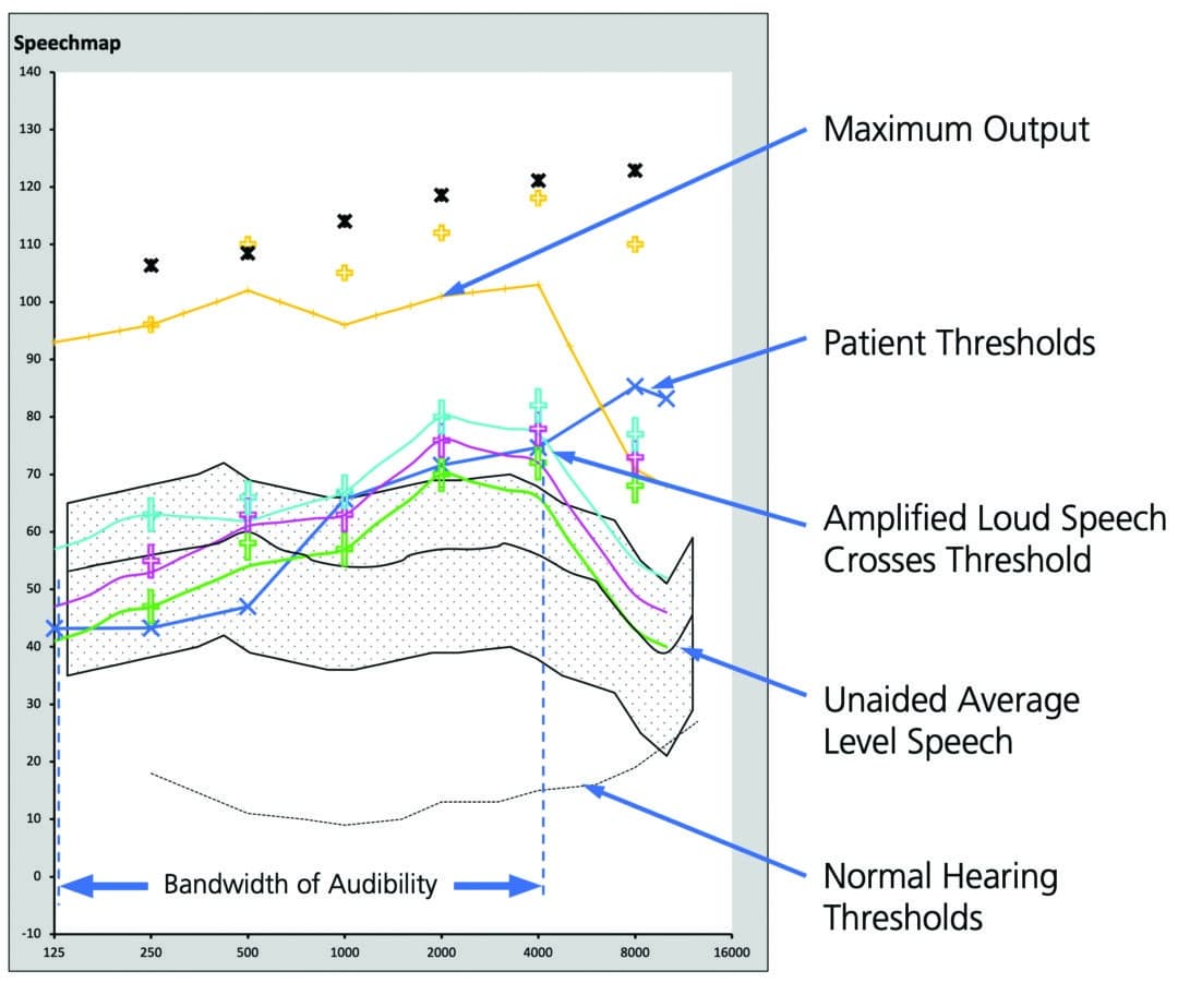 A 10-Year Review of the Earlens System, Part 3: What's the Big Deal ...